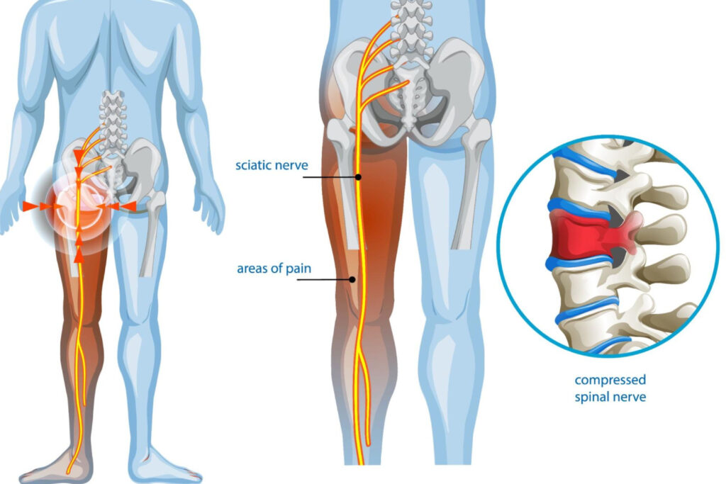 Sciatica Pain: Causes, Symptoms & How Physiotherapy Offers Long-Term Relief